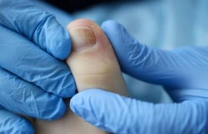 Blue Nails – Causes, Diagnosis, Prevention and More